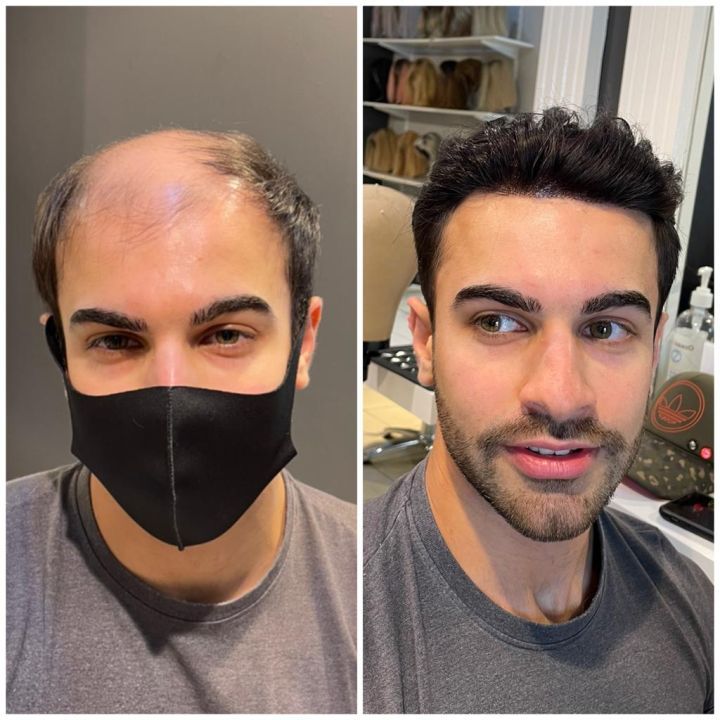 ALL YOU NEED TO KNOW ABOUT MEN'S HAIR REPLACEMENT SYSTEMS - Crown Couture